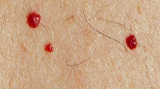 Co znamenají červené pupínky na kůži? - ProSvět.cz